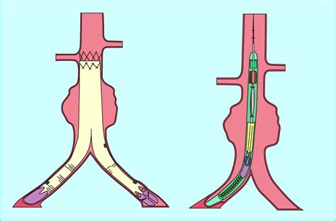 Arterial Aneurysms The Bmj