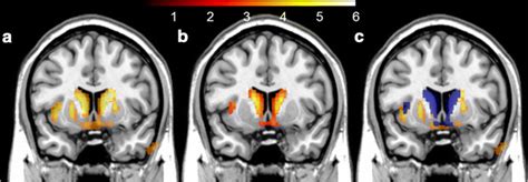 A Voxel Based Morphometry Vbm Results Reveal A Significant Reduction Download Scientific