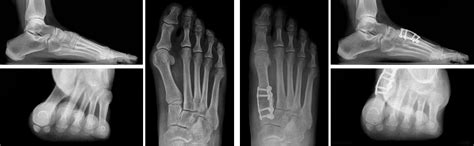 Clinical Results Treace Medical Concepts Inc