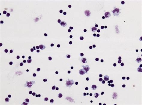 Meningitis Viral Csf