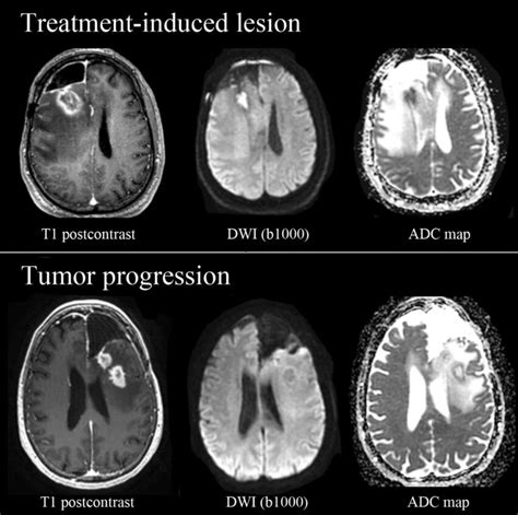 Examples Depicting The Inverted Adc Pattern In Treatment Induced Download Scientific Diagram