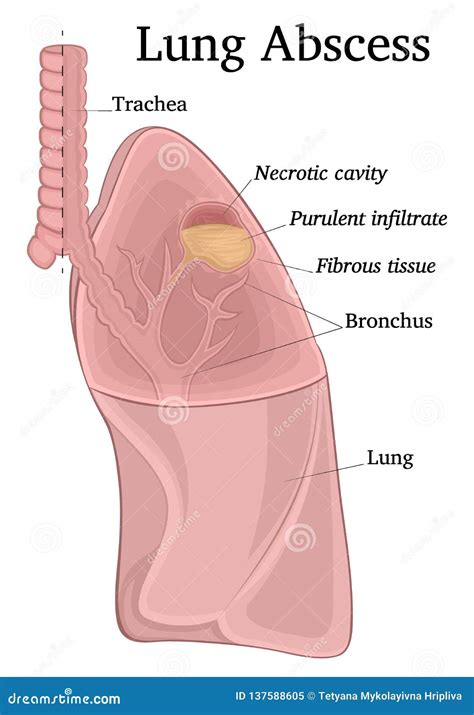 Illustration Of Lung Abscess Stock Vector Illustration Of Diagnosis
