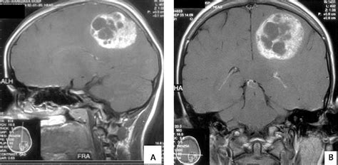 What Is An Ependymoma Tumor