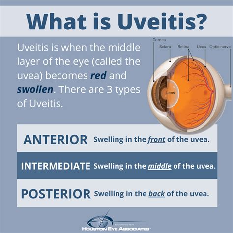 Uveitis Astonattique