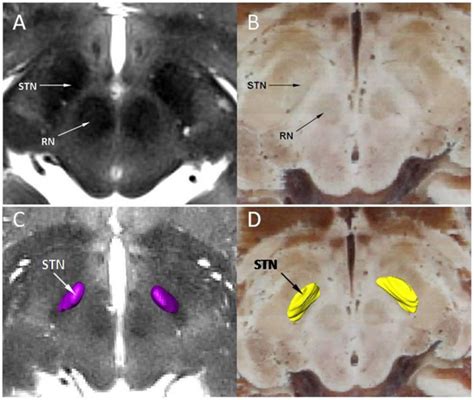 Subthalamic Nucleus Mri