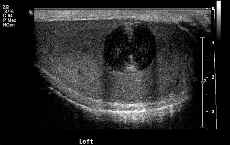 Epidermoid Cyst Of The Testicle Urology