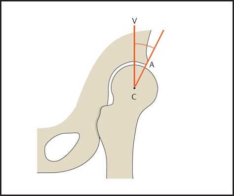 Hip Ii Radiology Key