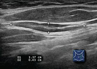 Ultrasound And Mapping Of Neck Lymph Nodes Radiology Key