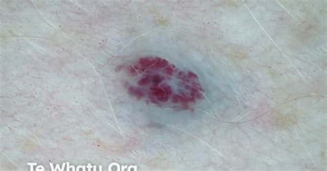 Cherry Angioma Dermoscopy Image