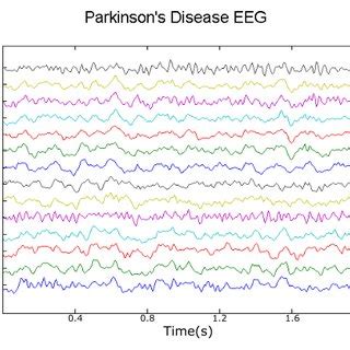Diagnosis Of Parkinsons Disease Using Computer Aided Tool Based On EEG