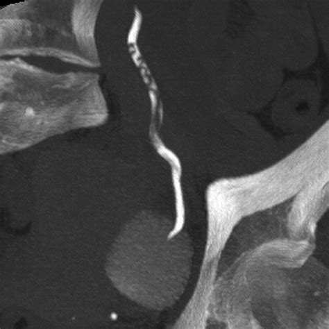 Ureteral Fibroepithelial Polyp On Mdct Urography Ajr