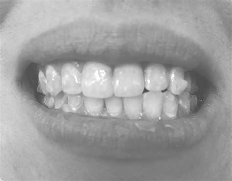 Permanent Retainer Rinvisalign