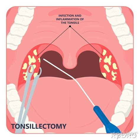 How To Use A Cotton Swab To Dislodge Tonsil Stones At Natasha Ransford Blog