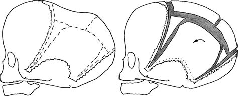 Scaphocephaly Part Ii Secondary Coronal Synostosis After Sc