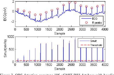 Figure 2 From Computationally Efficient Qrs Detection Analysis Based On