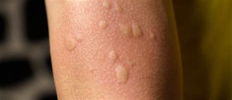 What Causes Hives When To Worry Upmc Healthbeat