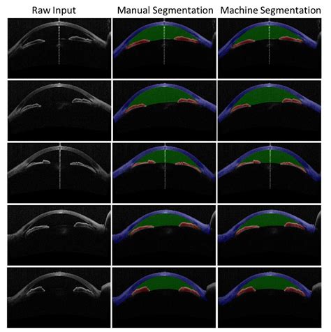 Deep Learning Algorithms To Isolate And Quantify The Structures Of The Anterior Segment In