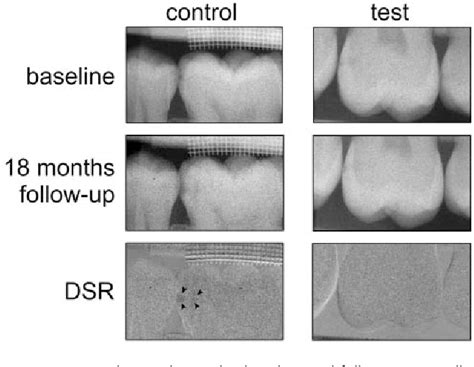Resin Infiltration Of Caries Lesions Semantic Scholar