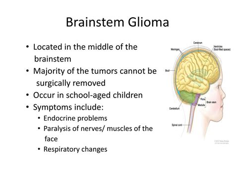 Ppt Pediatric Brain Tumors Powerpoint Presentation Free Download Id 2178317