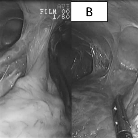 Operative Pictures From The Third Resection S4 Partial Hepatectomy