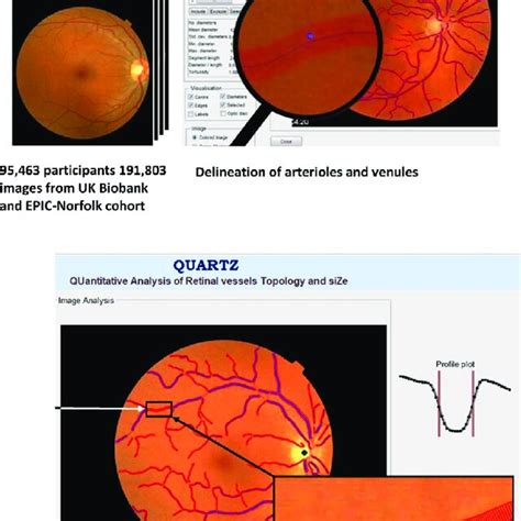 Fully Automated Retinal Image Processing Of The Vascular Tree Using Download Scientific Diagram