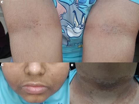 A Woman With Erythematous Rash Over Flexures And Face Tofacitinib