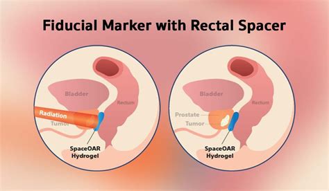 Fiducial Marker With Rectal Spacer Mens Health Thailand