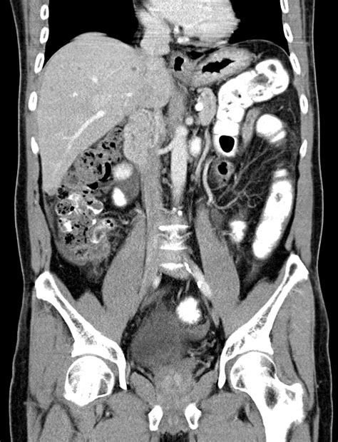 Appendiceal Mucocoele Image