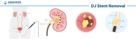 Ablation De La Sonde Jj Guide De Lintervention Et Durée De La