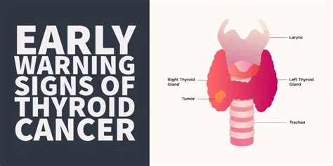 Thyroid Cancer Signs Symptoms And Complications 41 Off