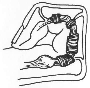 Trigger Finger Virginia Hand Center