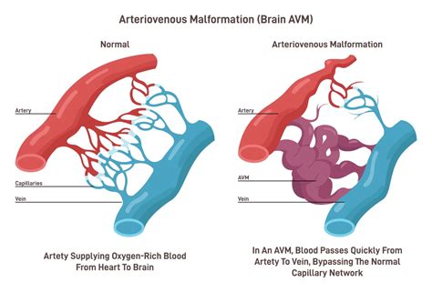 Arteriovenous Malformations Advocate Health Care