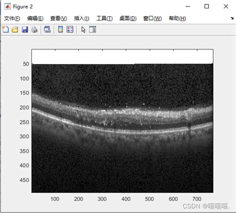2015boechiu2 杜克大学oct数据集 Csdn博客