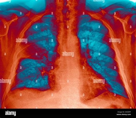 Pneumococcal Pneumonia Coloured Frontal X Ray Of A Section Through The Chest Of A 60 Year Old