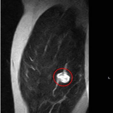 An Encysted Hematoma With Central Calcification And Fatty Infiltration Download Scientific