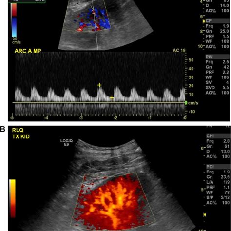Spectral Doppler Waveforms Ultrasound And Color Power Image Of The Download Scientific Diagram