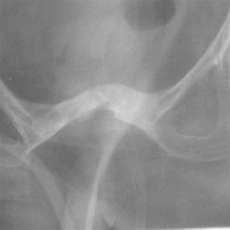 Pdf Synostosis Between Pubic Bones Due To Neurogenic Heterotopic