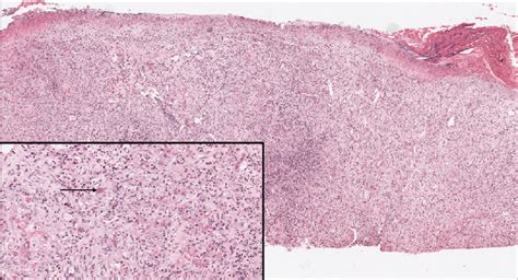 Bacillary Angiomatosis The Dermis Contains A Nodular Infiltrate Of Download Scientific Diagram