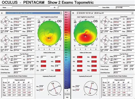 Oculus Pentacam Sagittal Curvature Maps Of Ou In Asymmetric Keratoconus Download Scientific