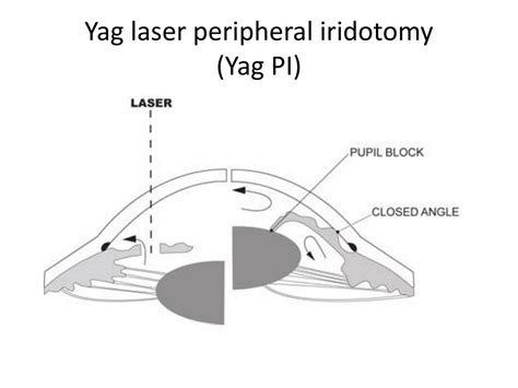Ppt Glaucoma Powerpoint Presentation Free Download Id2028894