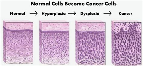 Everything You Need To Know About Cervical Dysplasia Hpv Hub Llc