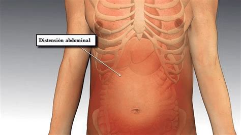 Distensión Abdominal Vital Health