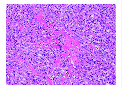 Primary Radiation Induced Soft Tissue Osteosarcoma In 2010 From The