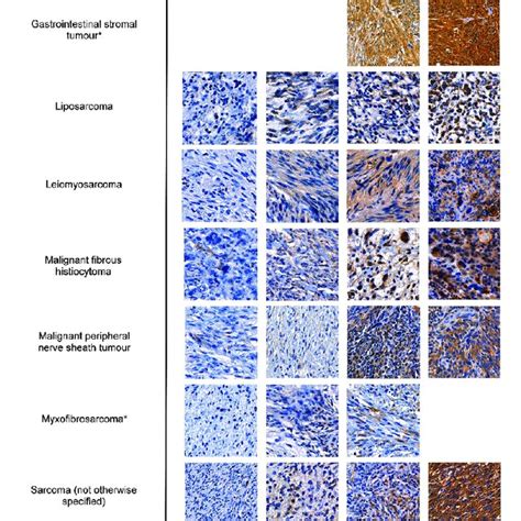 Pde3a Ihc Staining Results Of Soft Tissue Sarcoma Sample Series Download Scientific Diagram