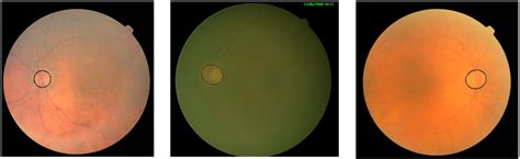 localization and segmentation of optic disc in retinal images using