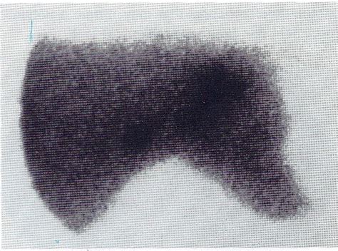 A 99mtc Pertechnetate Thyroid Scan Of A 2 2g Taken With The Window Set