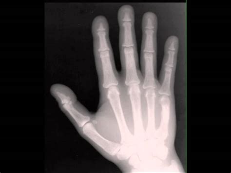 Hyperparathyroidism X Ray