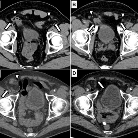 Two Examples Of Combined Inguinal Hernias Top Row A B Shows Axial Ct