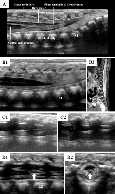 Outcome Of Ultrasonographic Imaging In Infants With Sacral Dimple Pmc