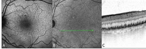 Imaging Of Reticular Pseudodrusen Example Of Reticular Pseudodrusen Download Scientific